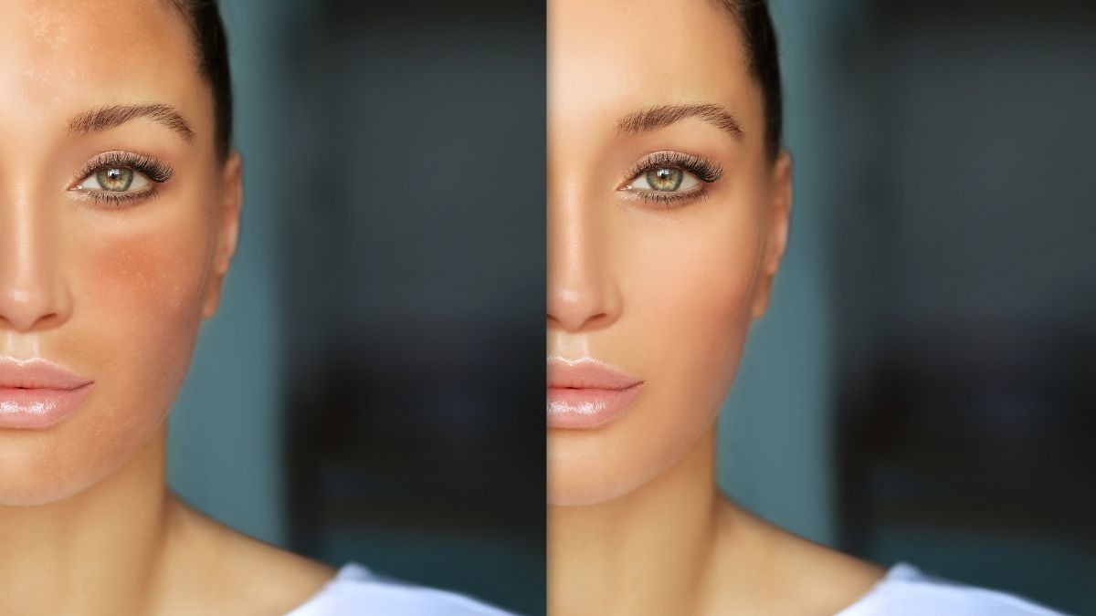 Pigmentasi 2024 – Dr Marissa Face Expert