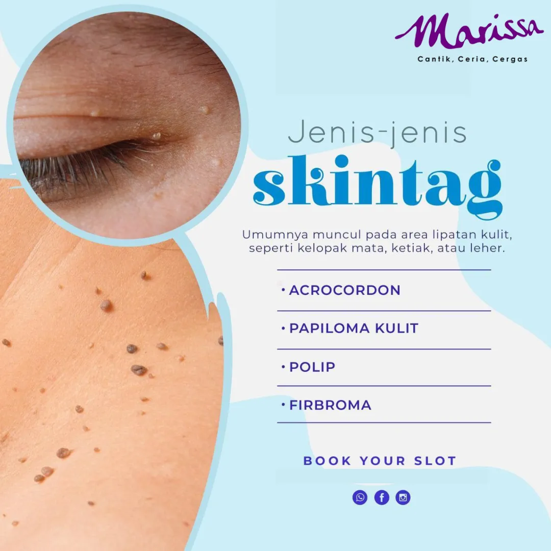 milia-skin-tag – Dr Marissa Face Expert